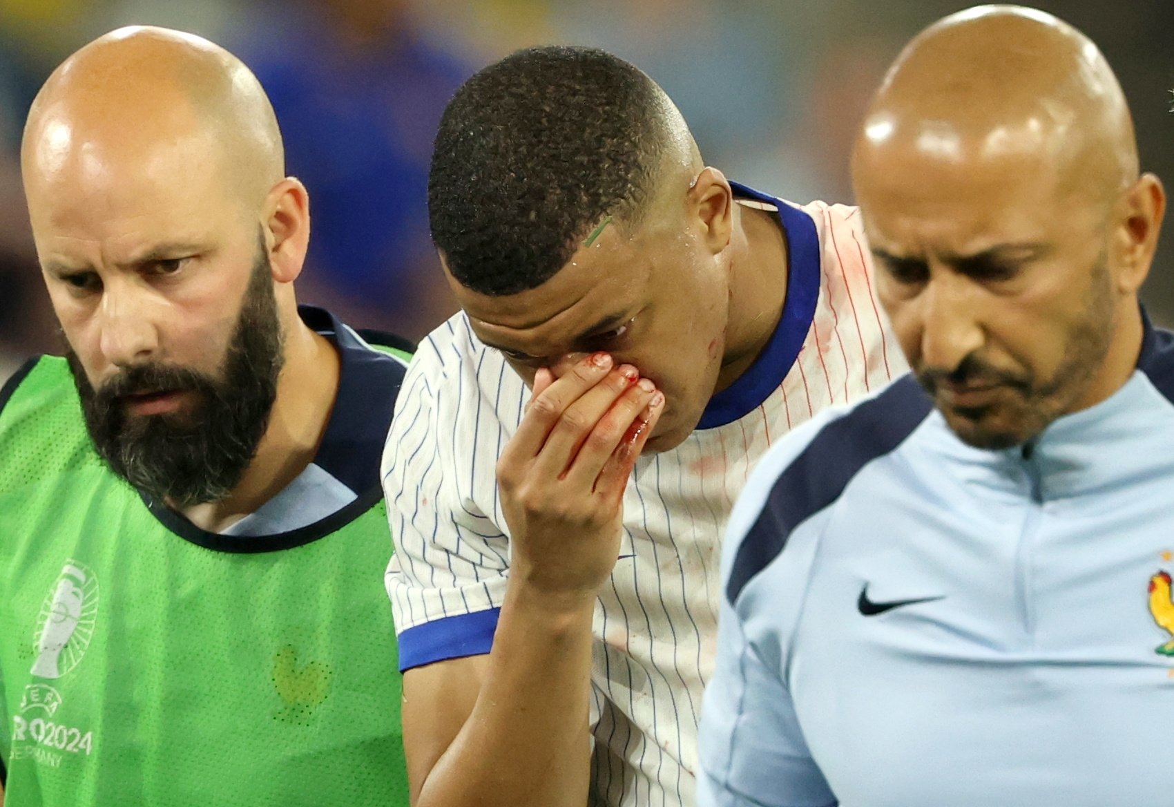 NEW DEVELOPMENTS ON KYLIAN MBAPPE'S NOSE INJURY | Sbnews
